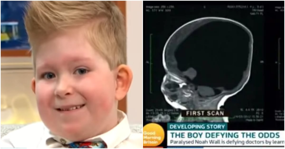 How Noah Wall, the boy born with How Noah Wall, the boy born with